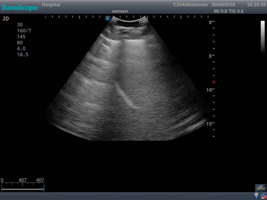 Thoracentesis Ultrasound Training Model - Pristine Medical