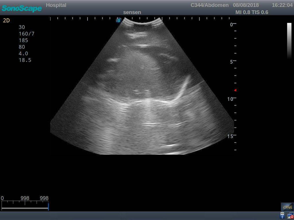 Anatomy Lab Thoracentesis Ultrasound Training Model — Pristine Medical